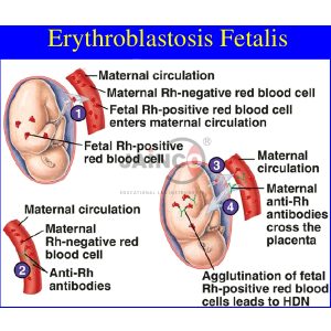 Erythroblastosis Fetalis - AnthroMania